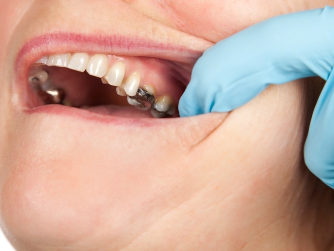 Wisdom Tooth Filling